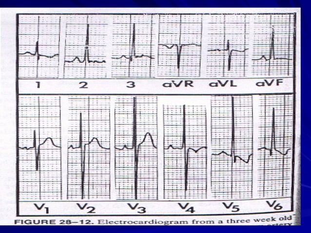 TRUNCUS ARTERIOSUS,TRUNCUS ARTERIOSUS,.ppt.ppt