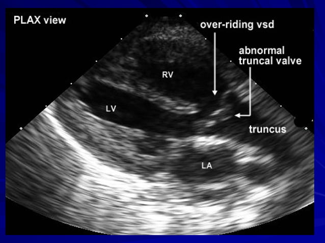 TRUNCUS ARTERIOSUS,TRUNCUS ARTERIOSUS,.ppt.ppt