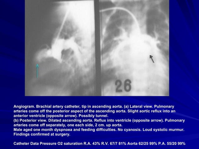 TRUNCUS ARTERIOSUS,TRUNCUS ARTERIOSUS,.ppt.ppt