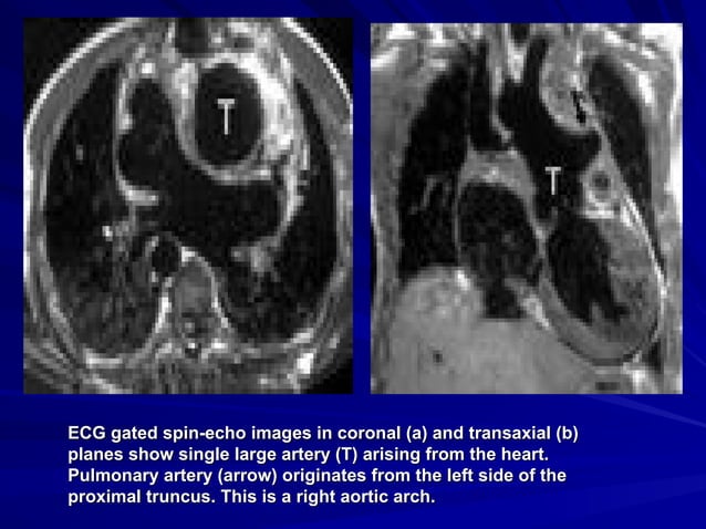 TRUNCUS ARTERIOSUS,TRUNCUS ARTERIOSUS,.ppt.ppt