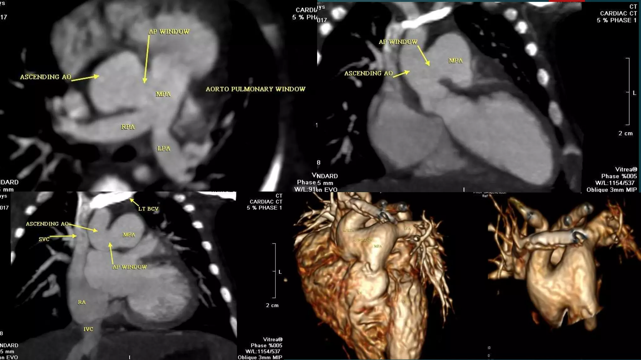 Truncus arteriosus - Hemitruncus - Pseudotruncus CT role | PPT