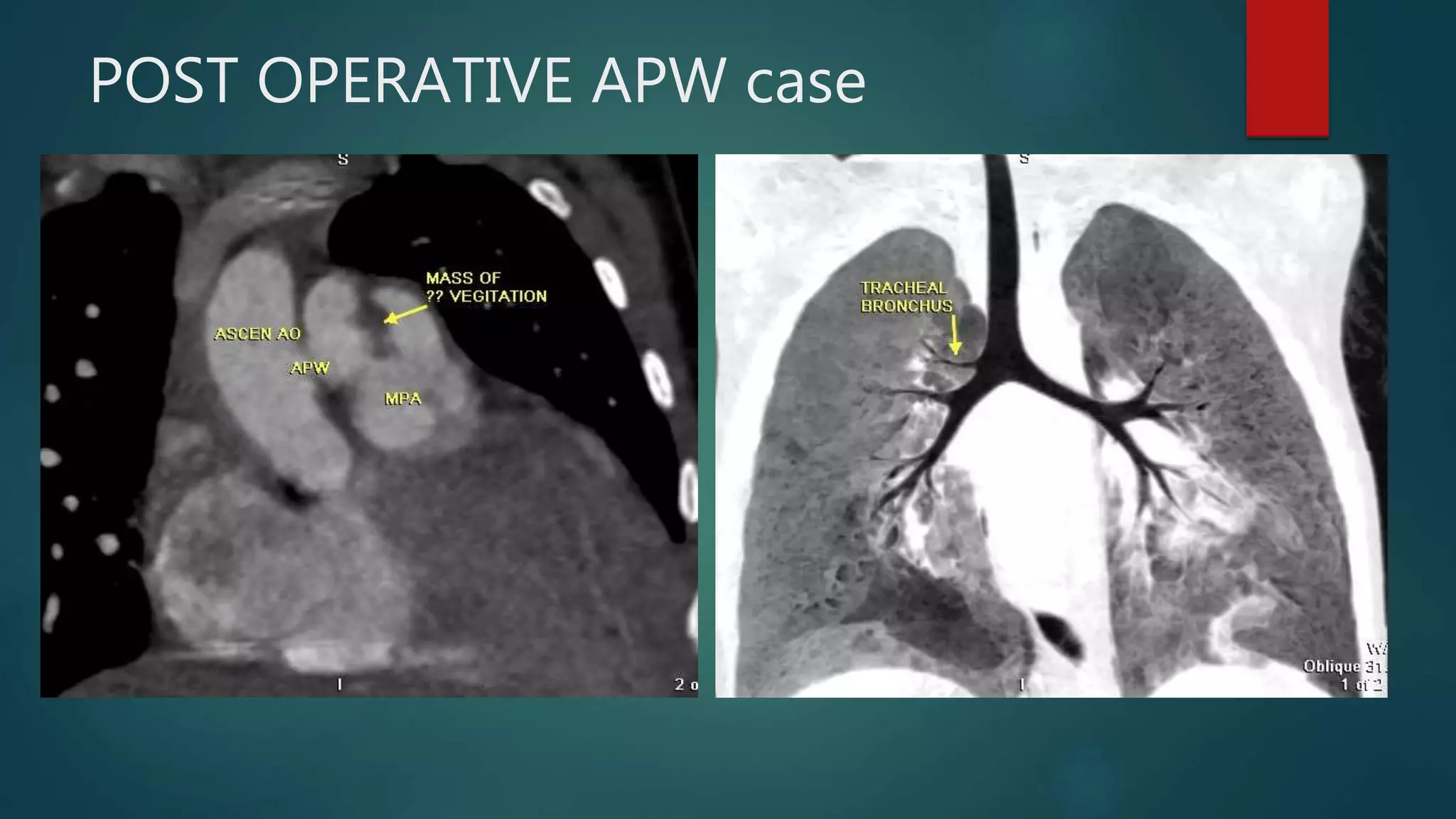 Truncus arteriosus - Hemitruncus - Pseudotruncus CT role | PPT