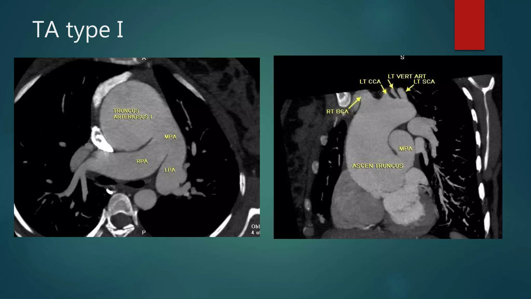 Truncus arteriosus - Hemitruncus - Pseudotruncus CT role | PPT