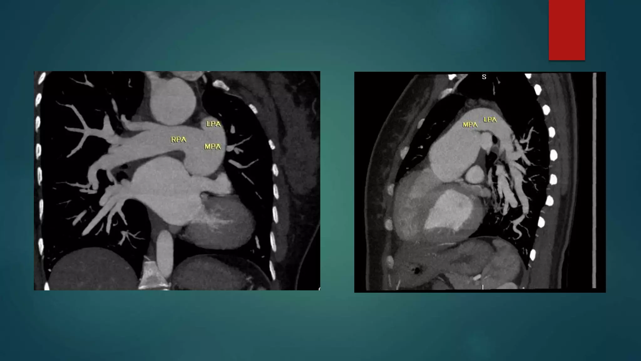 Truncus arteriosus - Hemitruncus - Pseudotruncus CT role | PPT
