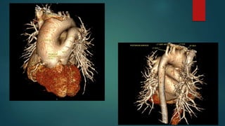 Truncus arteriosus - Hemitruncus - Pseudotruncus CT role | PPT