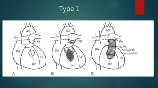 Truncus arteriosus - Hemitruncus - Pseudotruncus CT role | PPT
