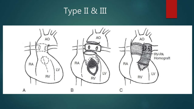 Truncus arteriosus - Hemitruncus - Pseudotruncus CT role | PPT