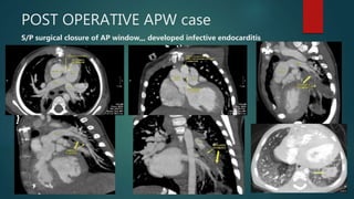 Truncus arteriosus - Hemitruncus - Pseudotruncus CT role | PPT