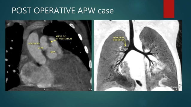 Truncus arteriosus - Hemitruncus - Pseudotruncus CT role | PPT