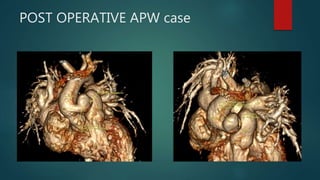 Truncus arteriosus - Hemitruncus - Pseudotruncus CT role | PPT