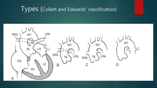 Truncus arteriosus - Hemitruncus - Pseudotruncus CT role | PPT