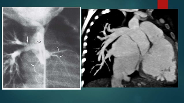 Truncus arteriosus - Hemitruncus - Pseudotruncus CT role | PPT