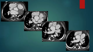 Truncus arteriosus - Hemitruncus - Pseudotruncus CT role | PPT
