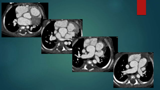 Truncus arteriosus - Hemitruncus - Pseudotruncus CT role | PPT