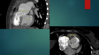 Truncus arteriosus - Hemitruncus - Pseudotruncus CT role | PPT