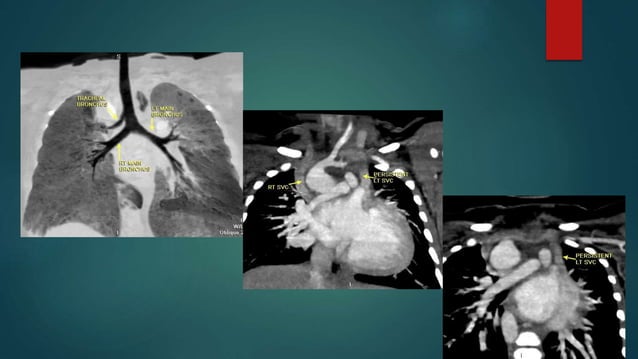 Truncus arteriosus - Hemitruncus - Pseudotruncus CT role