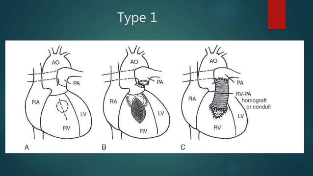 Truncus arteriosus - Hemitruncus - Pseudotruncus CT role
