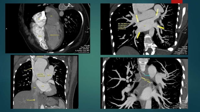 Truncus arteriosus - Hemitruncus - Pseudotruncus CT role