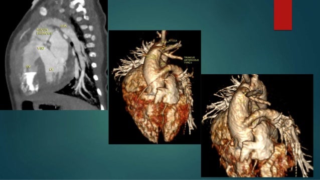 Truncus arteriosus - Hemitruncus - Pseudotruncus CT role