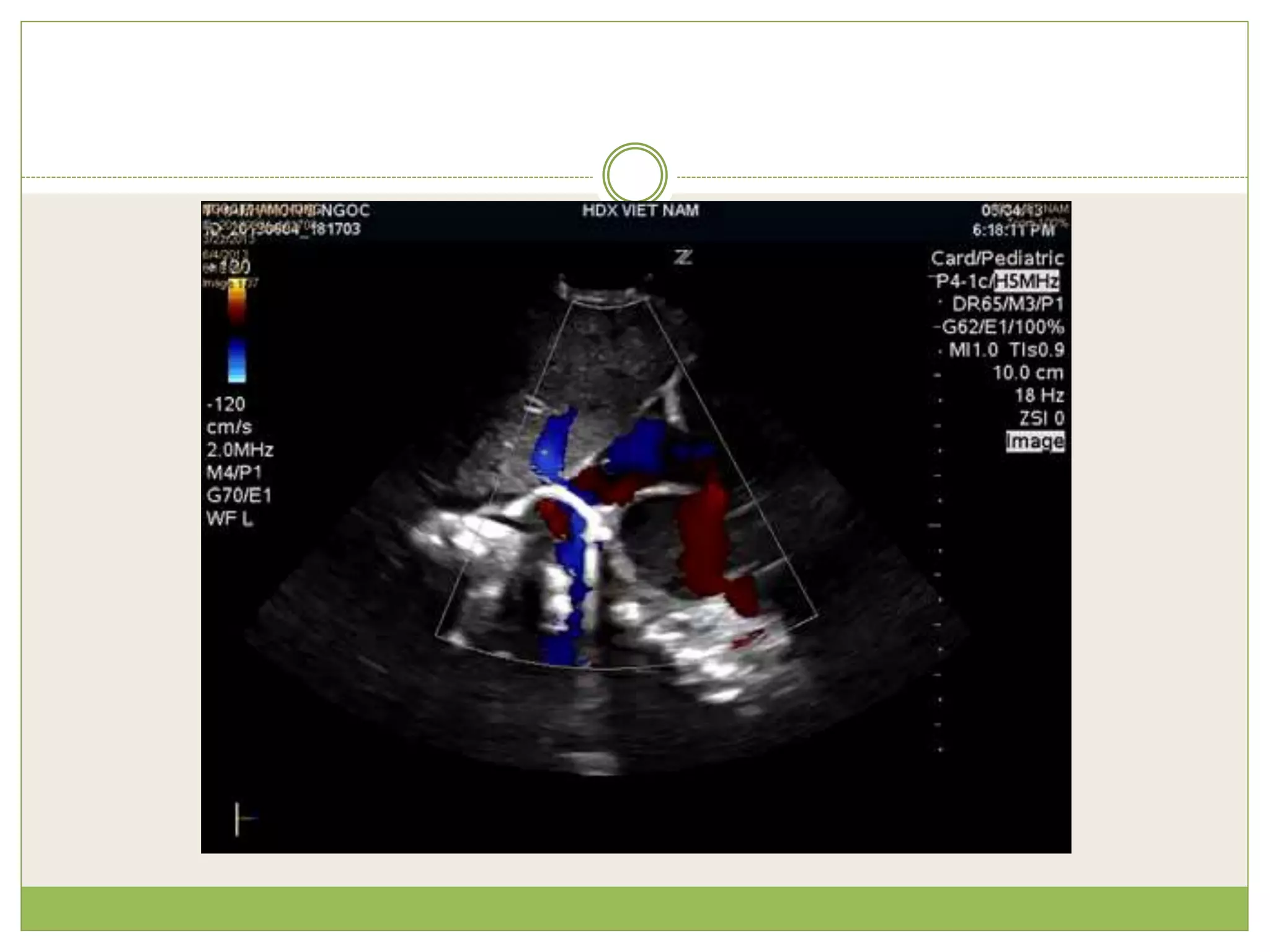 Truncus Arteriosus | PPTX