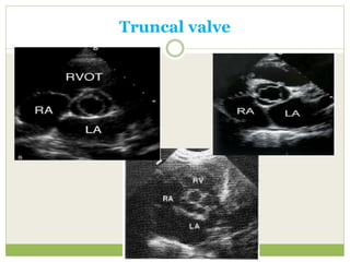 Truncus Arteriosus | PPTX