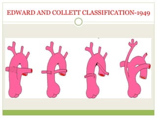Truncus Arteriosus | PPTX