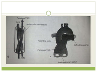 Truncus Arteriosus | PPTX