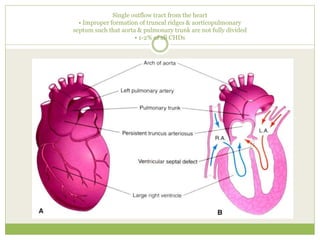 Truncus Arteriosus | PPTX