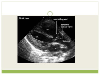 Truncus Arteriosus Echo