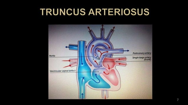 Truncus arteriosus by Dr Wali | PPTX | Heart and Cardiovascular ...