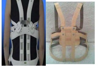 Trunk orthosis | PPTX