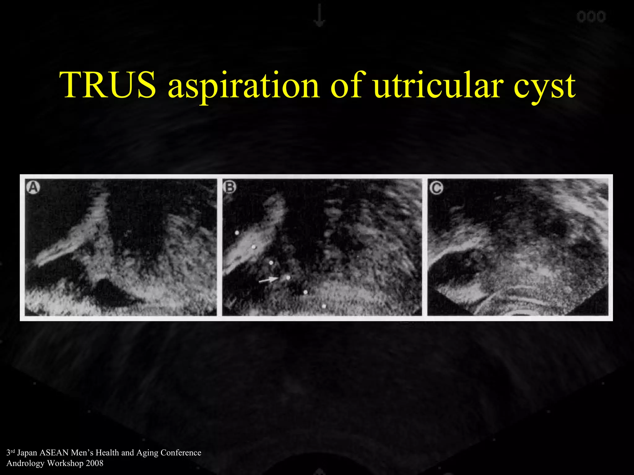 TRUS in Evaluation of Male Infertility | PPT