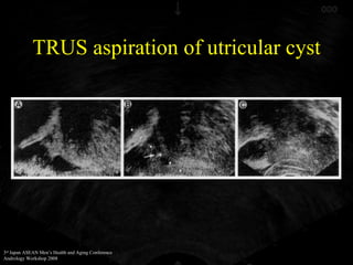 TRUS in Evaluation of Male Infertility | PPT