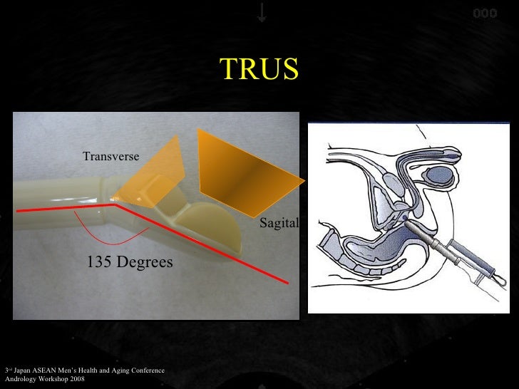 TRUS in Evaluation of Male Infertility