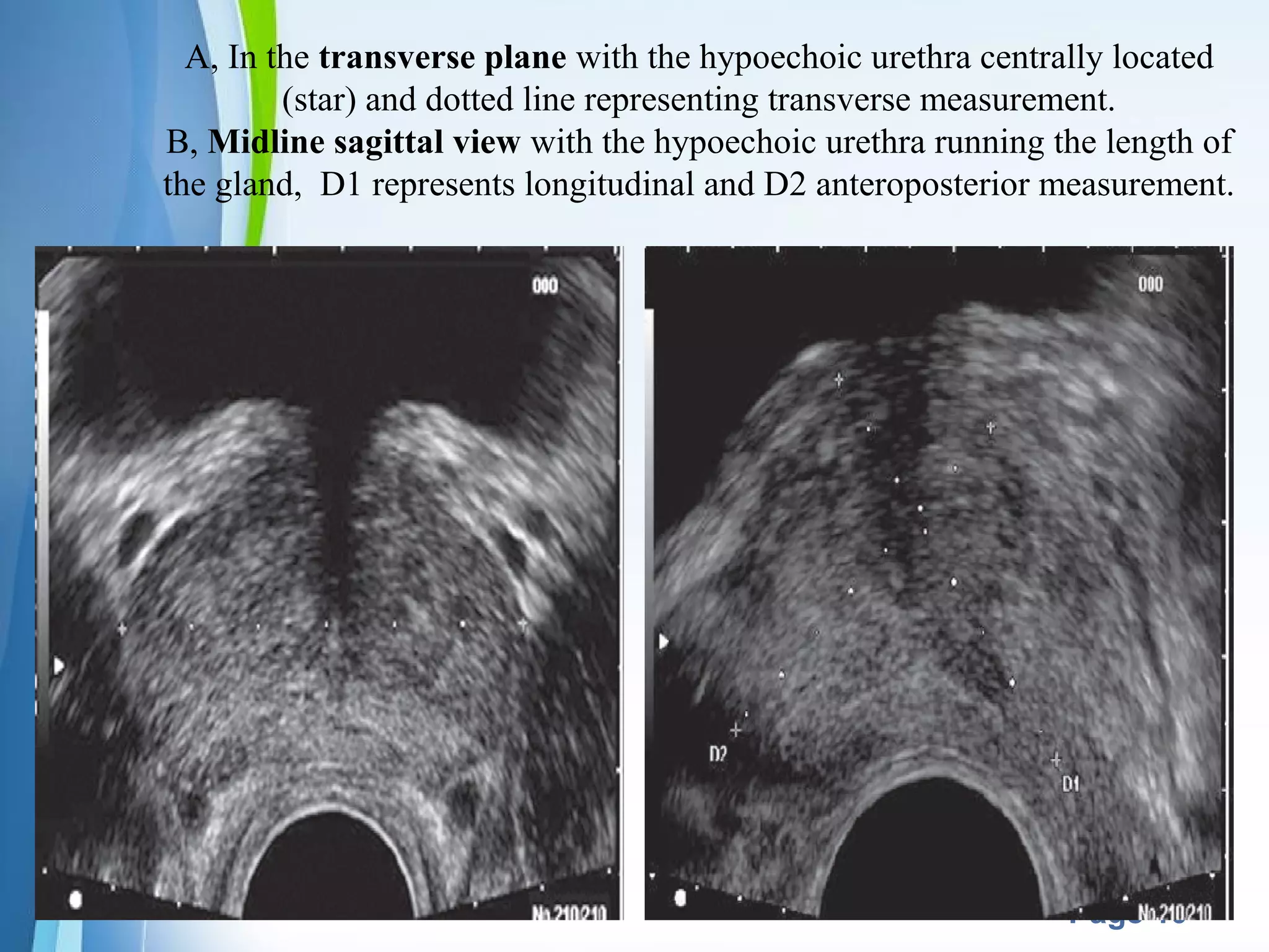 Trus biopsy prostate | PPT