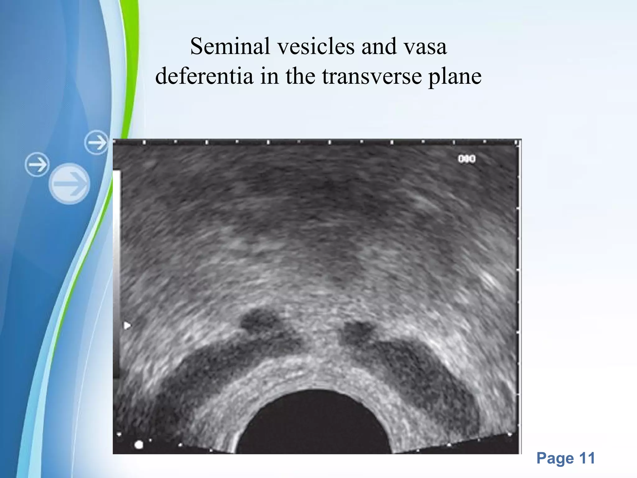 Trus biopsy prostate | PPT