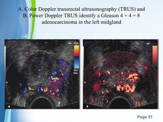 Trus biopsy prostate | PPT