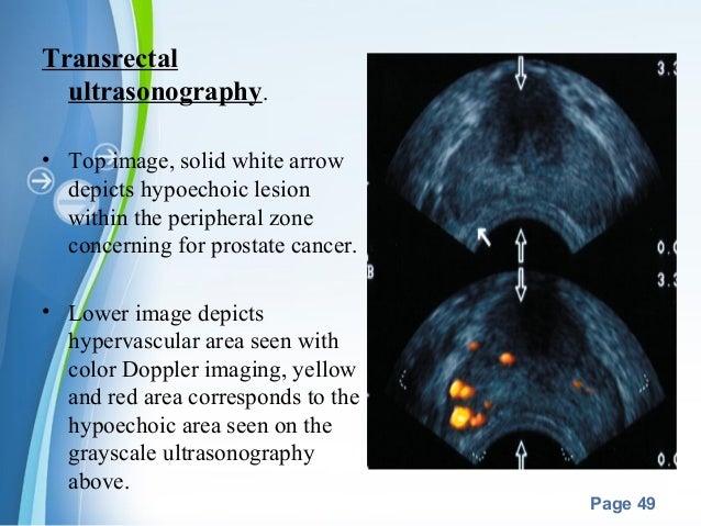 Trus biopsy prostate