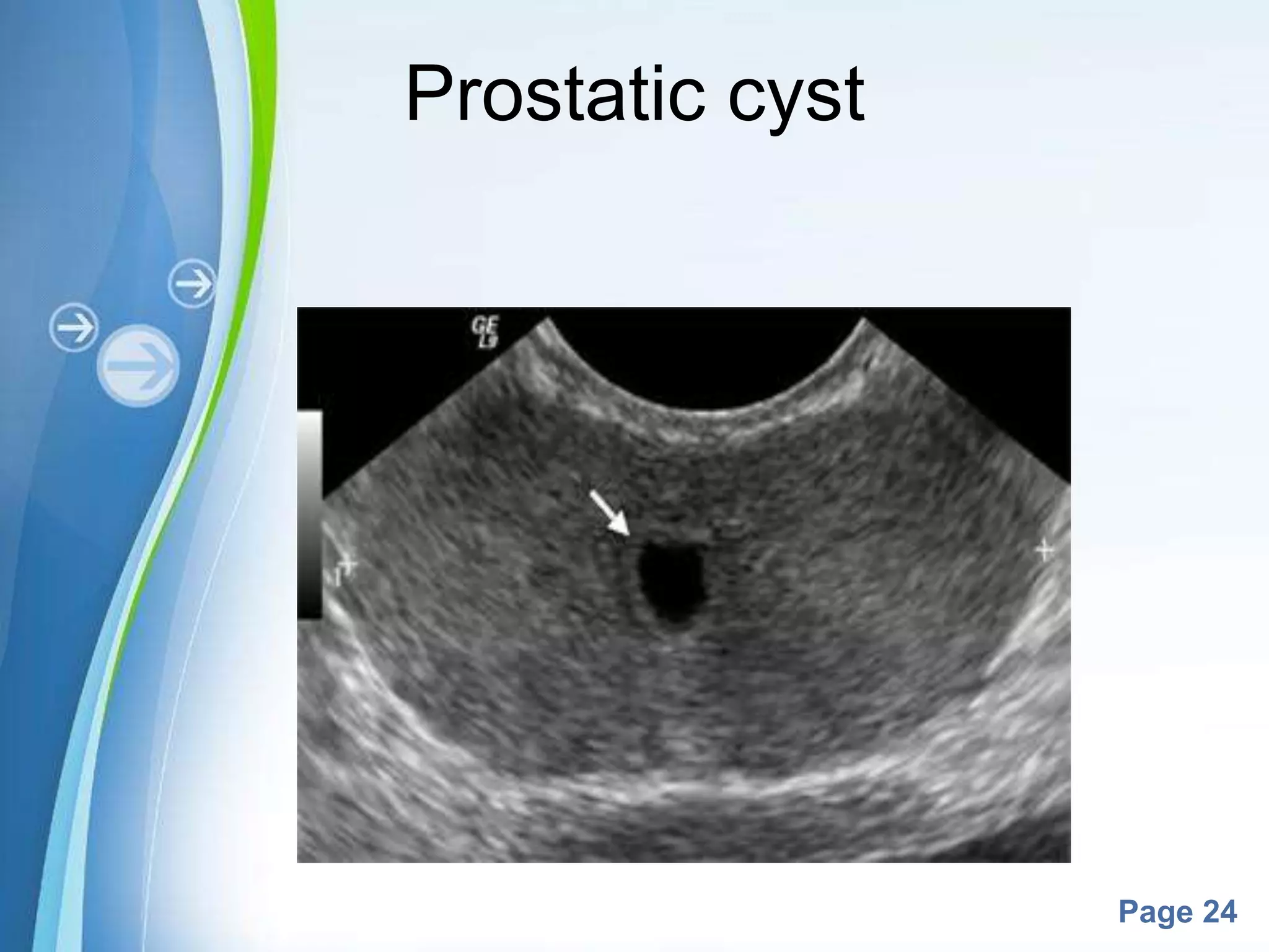 Trus biopsy prostate | PPTX