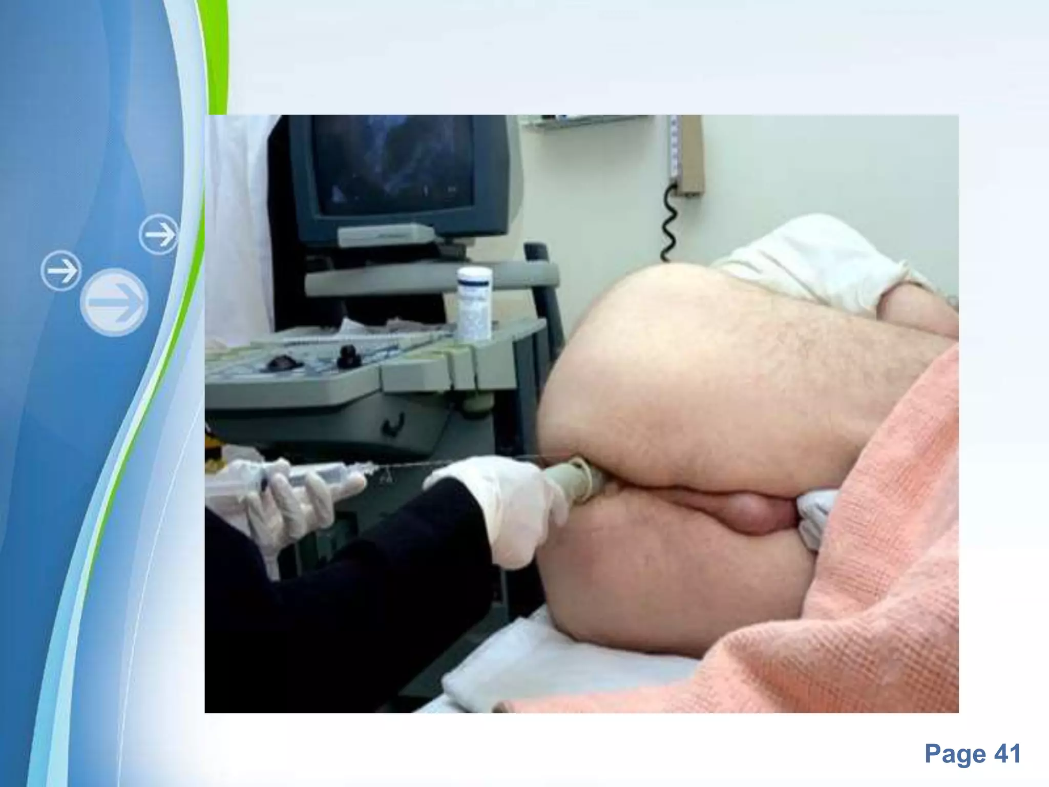 Trus biopsy prostate | PPTX