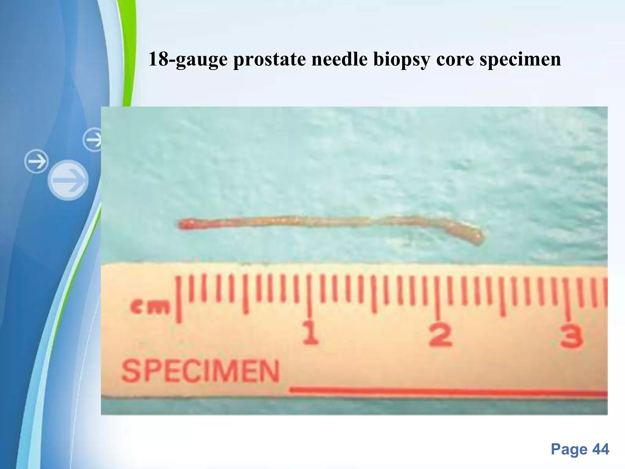 Trus biopsy prostate | PPTX