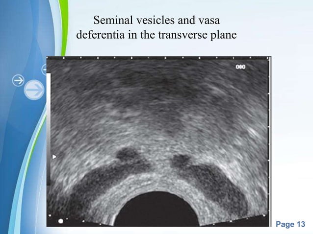 Trus biopsy prostate | PPTX | Medical Tests | Medical Health
