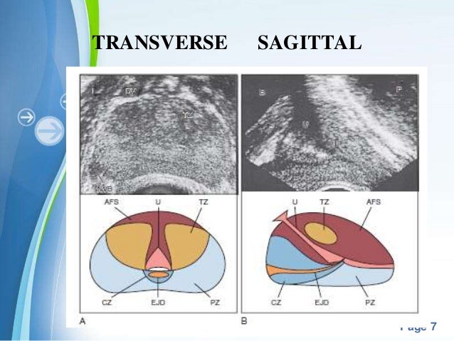 Trus biopsy prostate