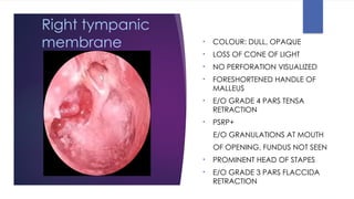 Mucosal csom and it's treatment protocol | PPT