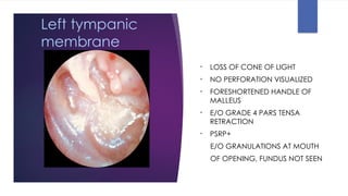 Mucosal csom and it's treatment protocol | PPT