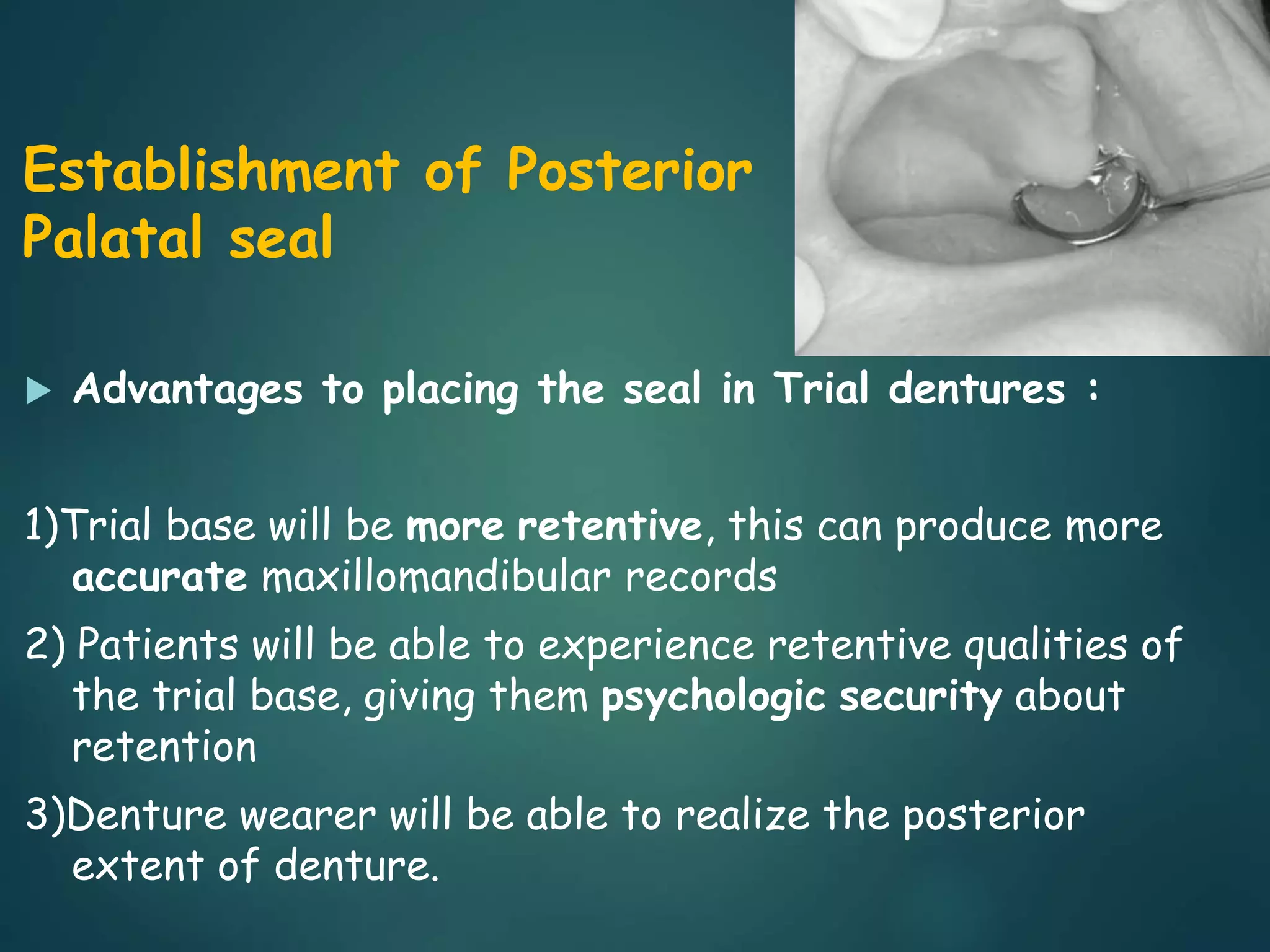 Try in of complete dentures | PPTX