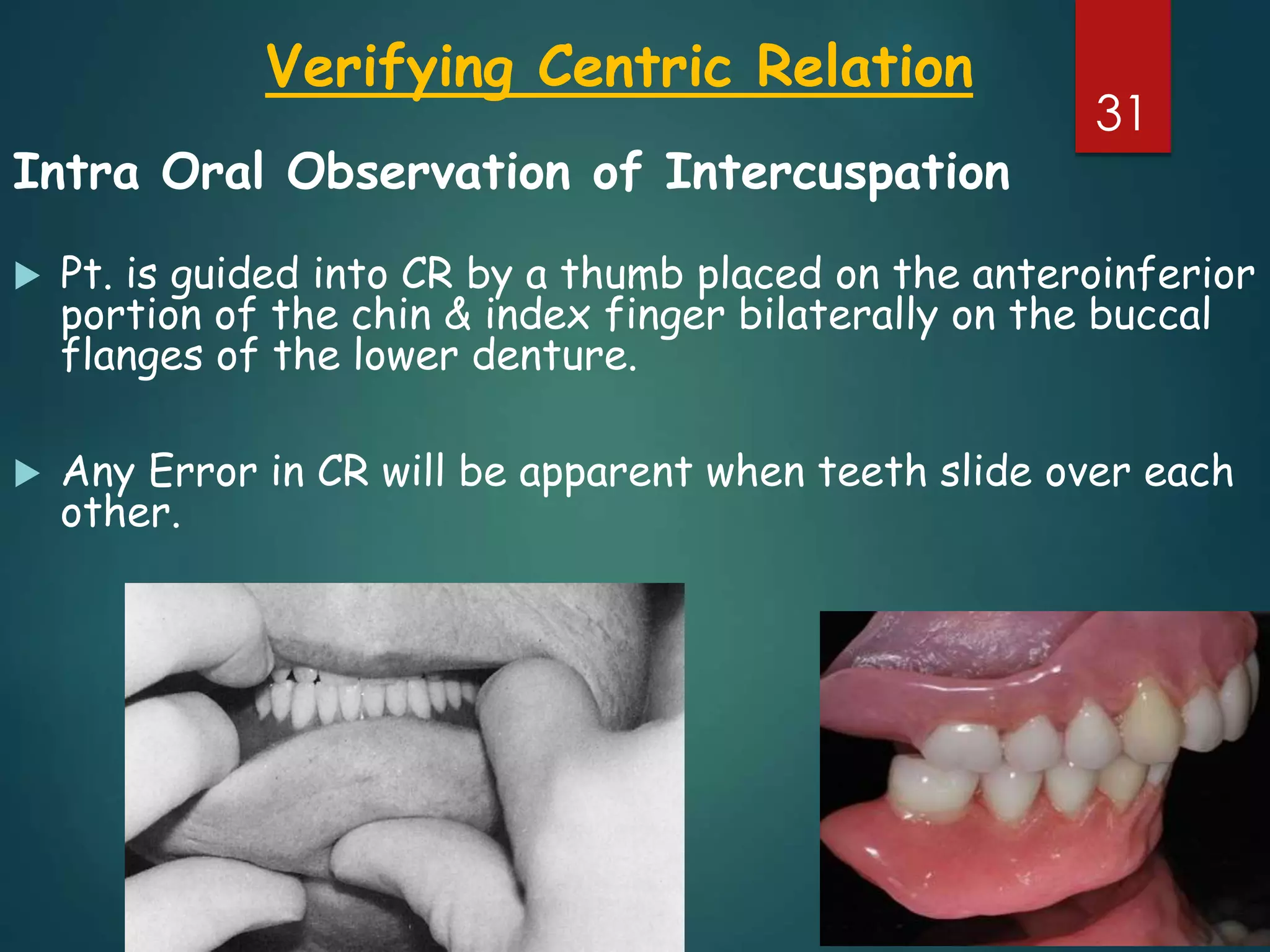 Try in of complete dentures | PPTX