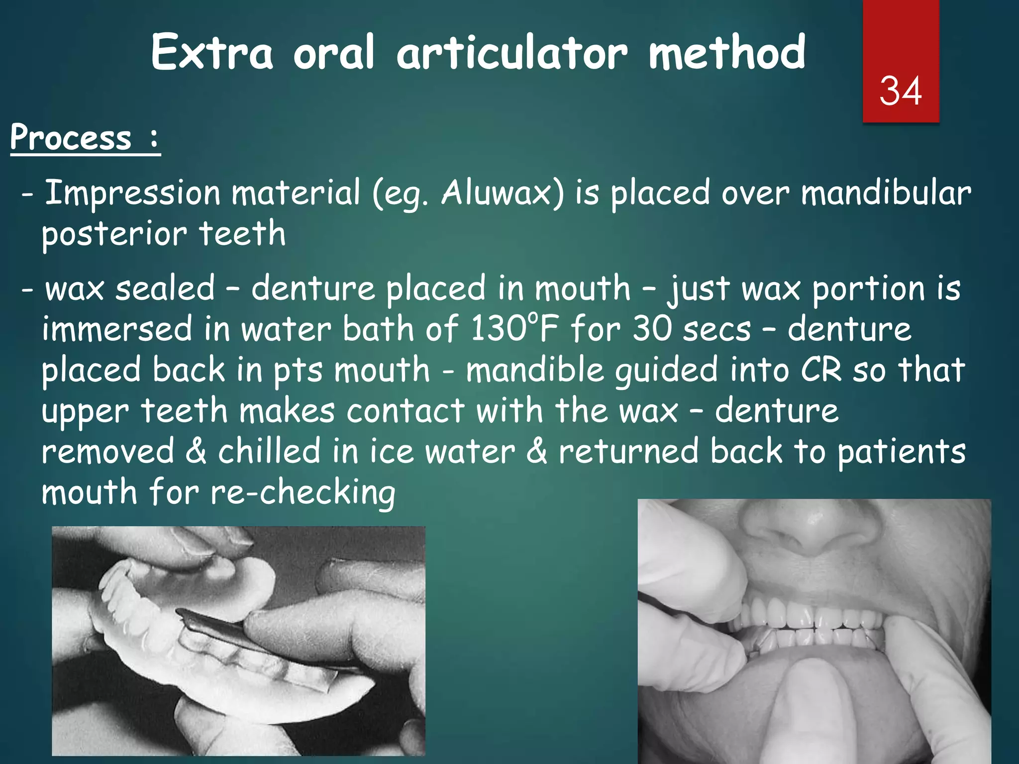 Try in of complete dentures | PPTX