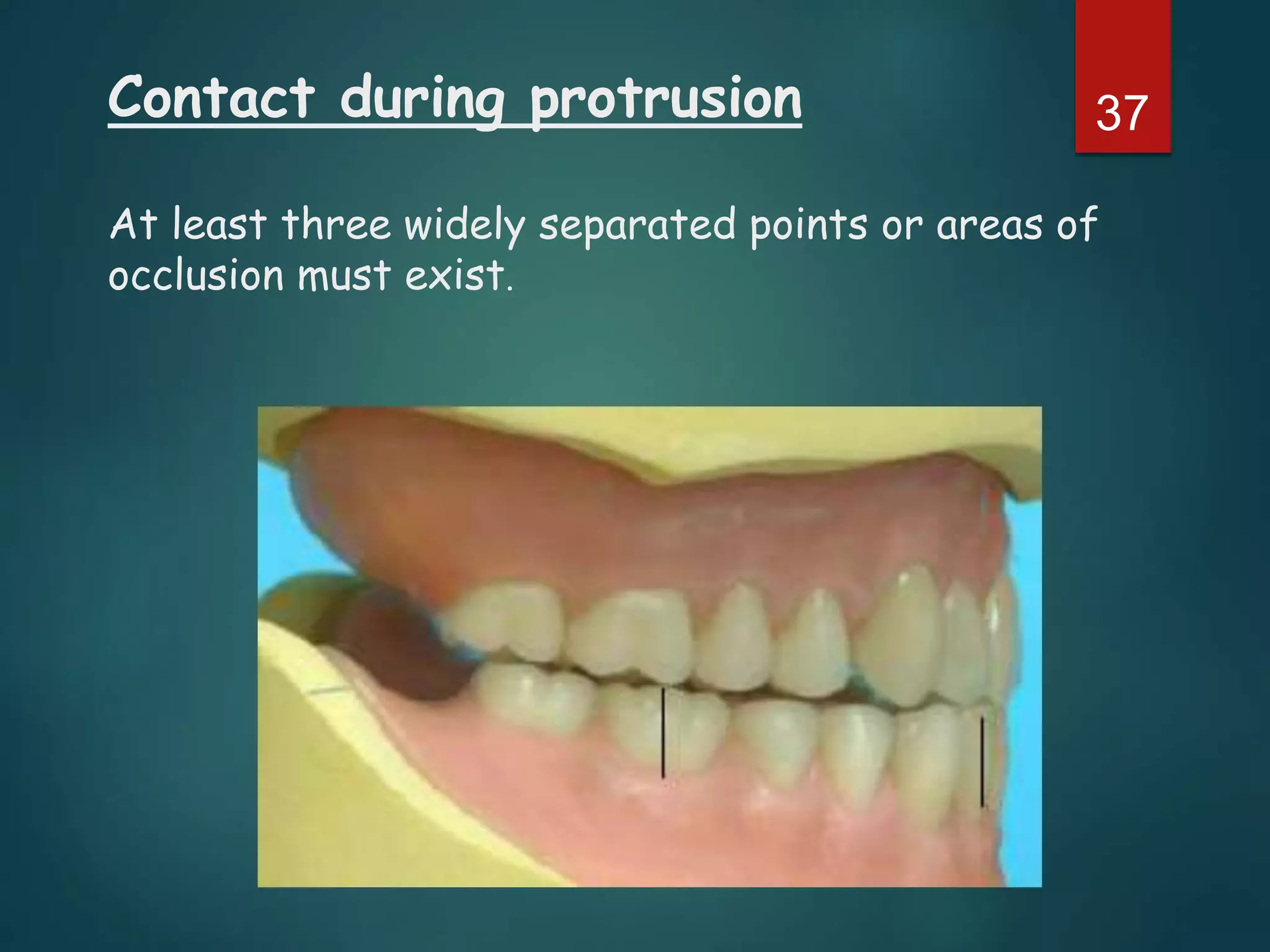 Try in of complete dentures | PPTX