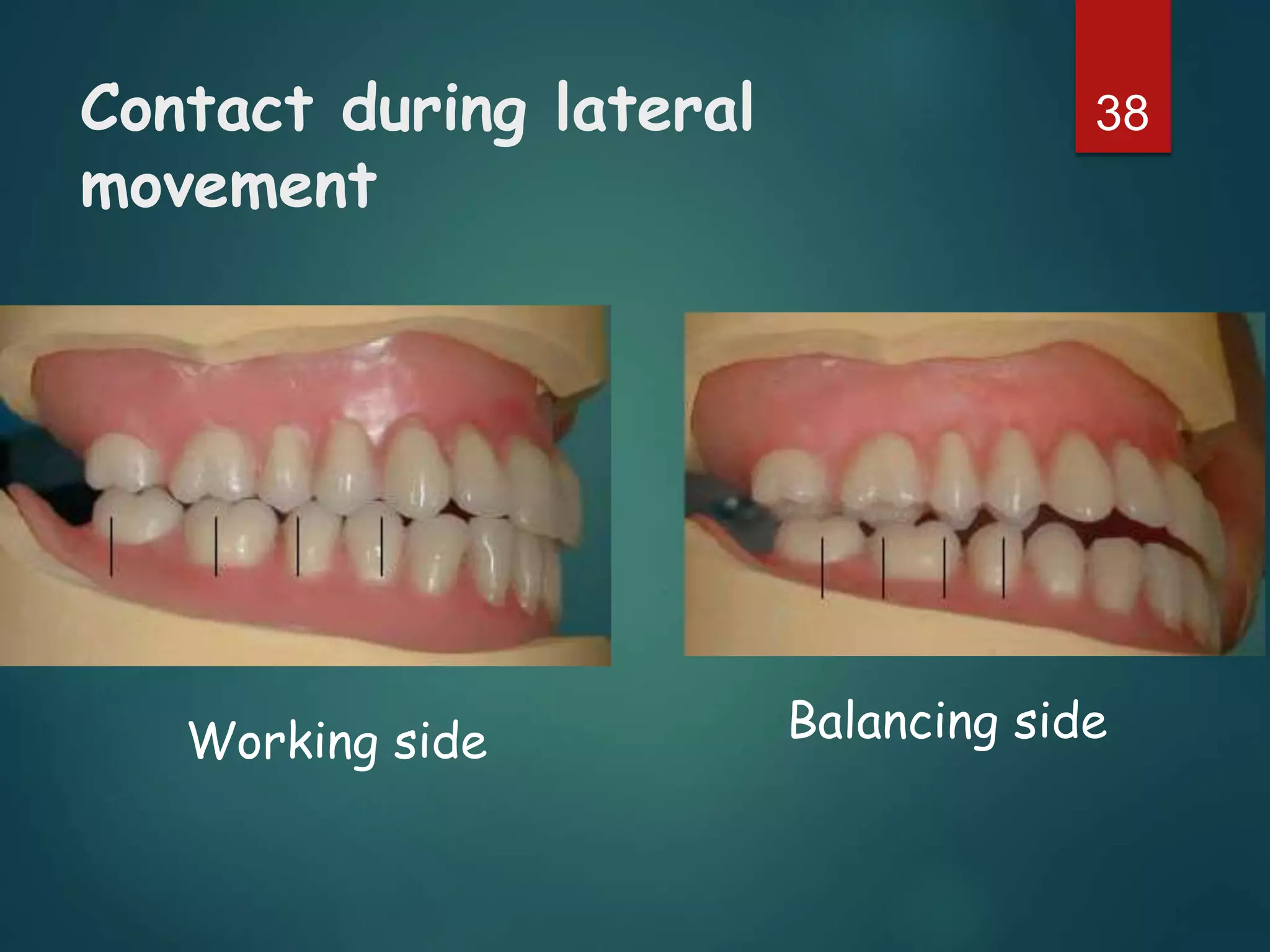 Try in of complete dentures | PPTX